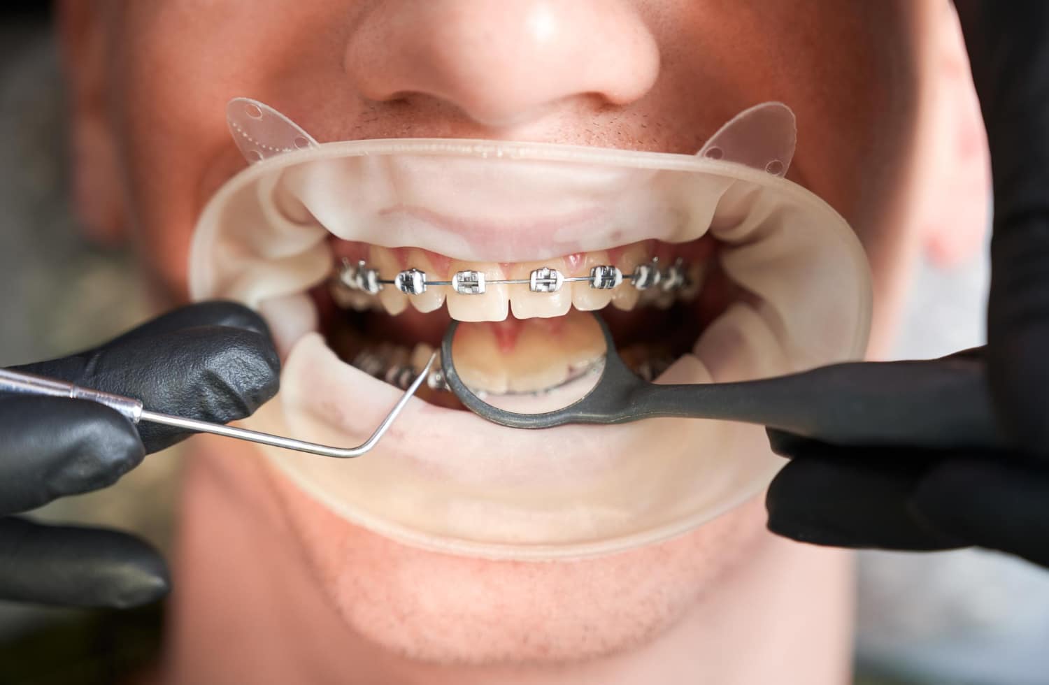 Does Getting Braces Hurt? 6 Pain-Relief Tips | Princeton